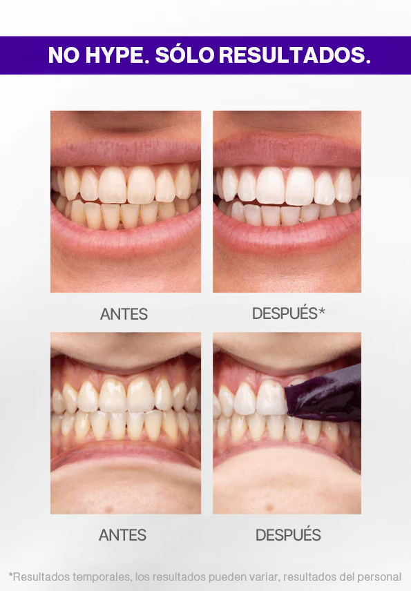 OBSESSIVE® | Advanced Teeth Whitening Kits
